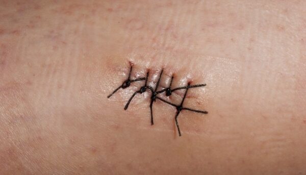 Do nurses Do Stitches? - Nurse Money Talk